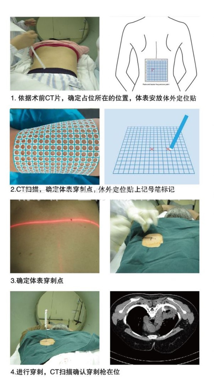 CT Scan of Body Surface Positioning Sticker Puncture Positioning ...